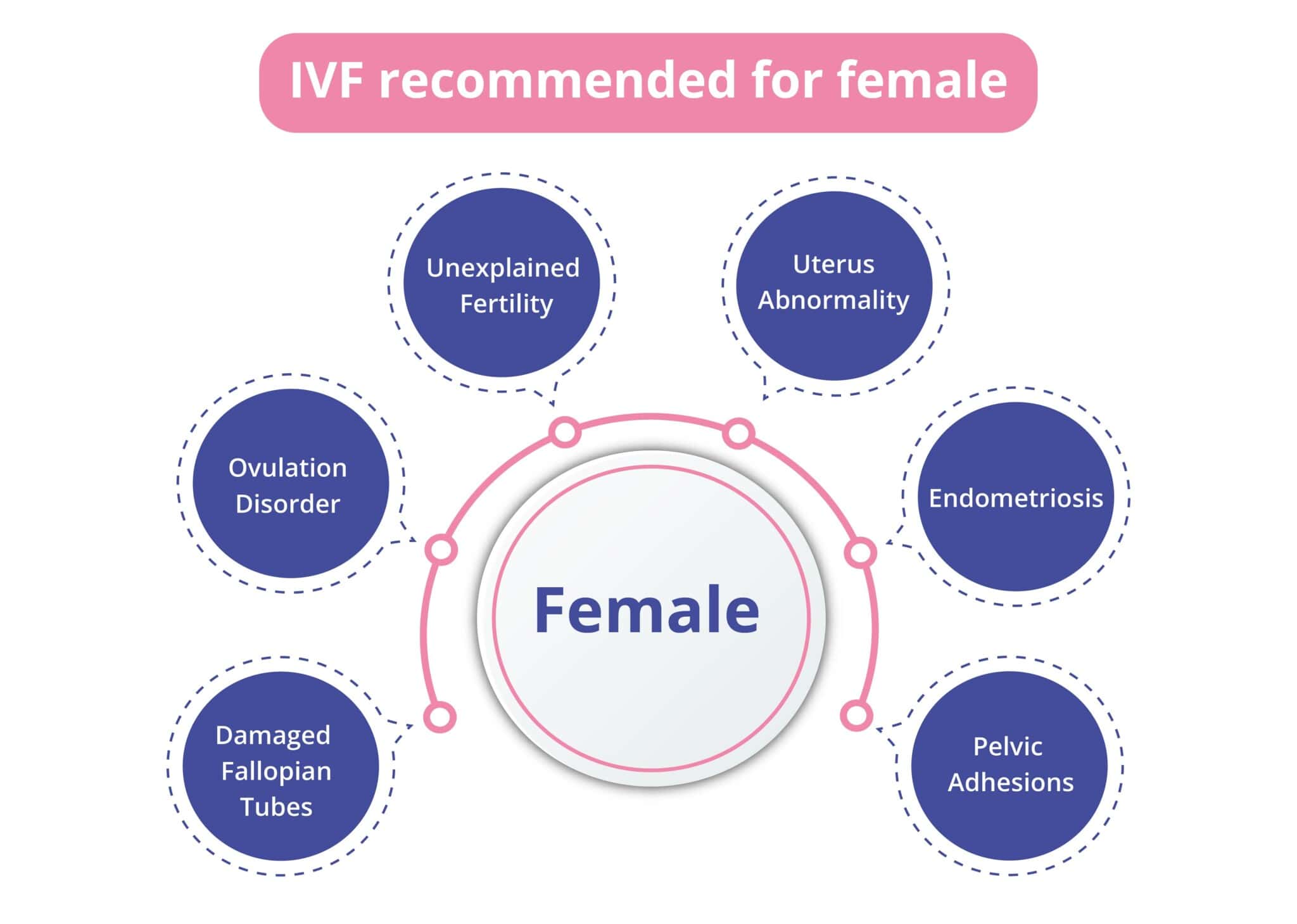IVF (In Vitro Fertilization): Procedure, Treatment, Do's & Don'ts